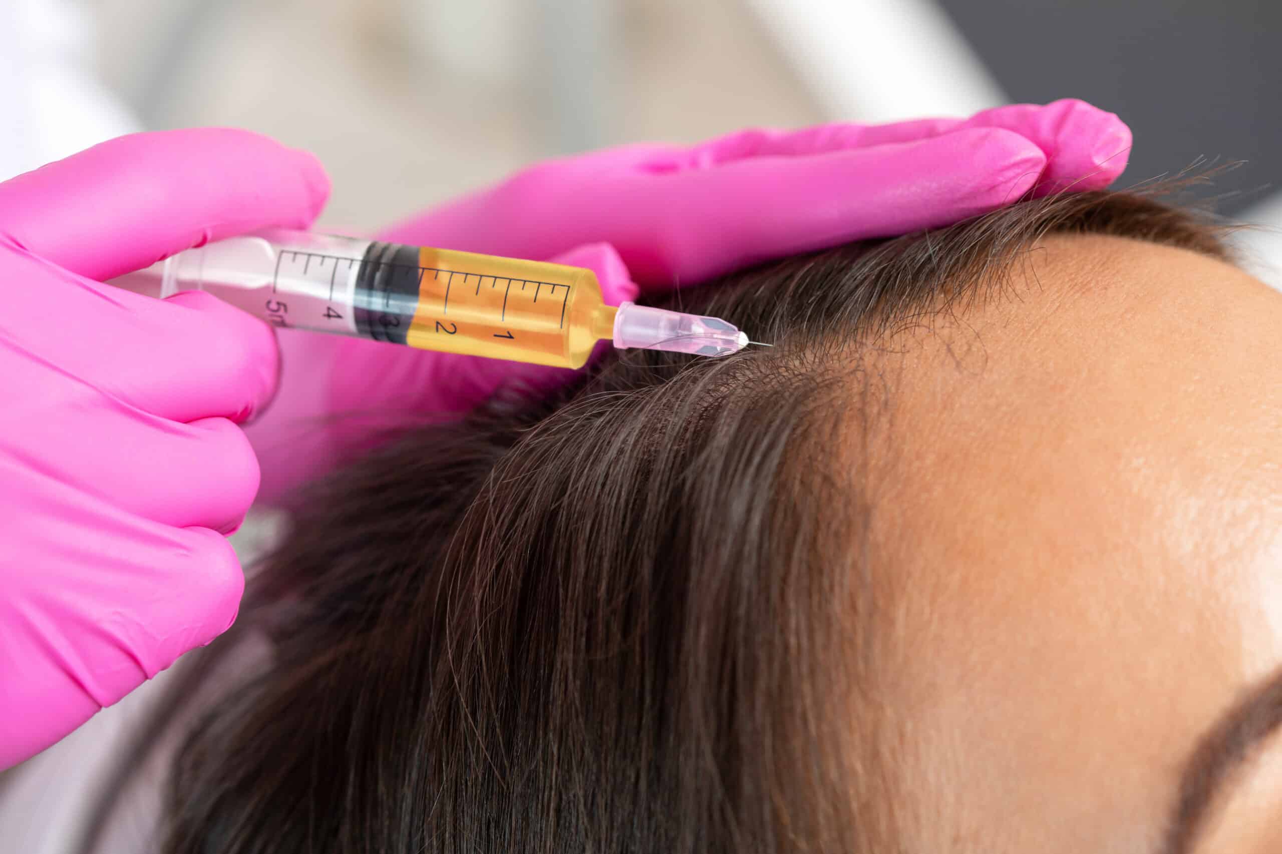 PRP Injections for Hair Loss: A Comprehensive Guide - H-Shot PRP Injections for Hair Loss: A Comprehensive Guide - H-Shot